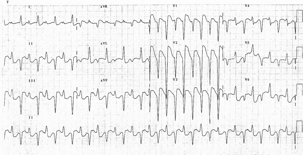 EKG in Tox — Maimonides Emergency Medicine Residency