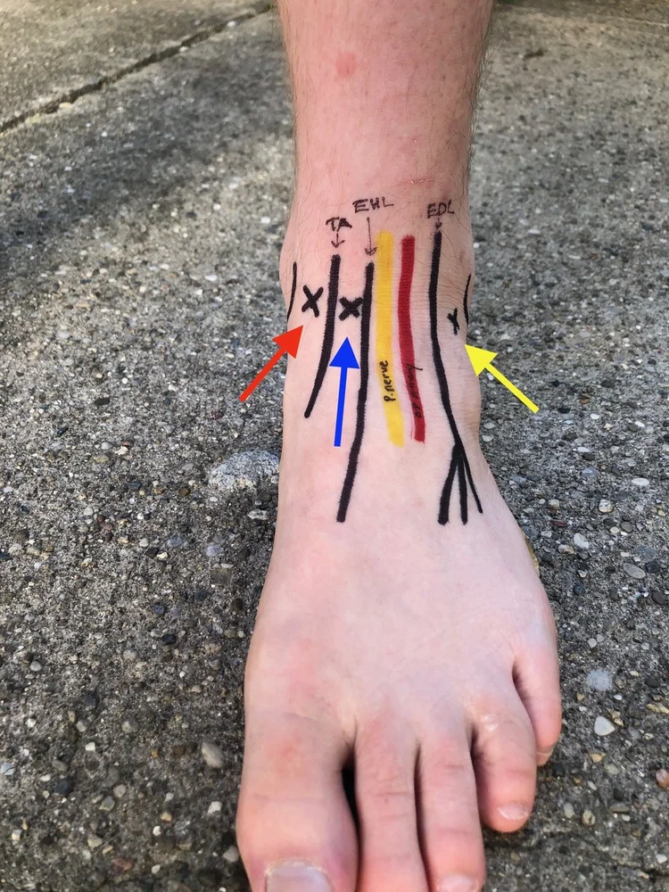 Joint Aspiration: Ankle — Maimonides Emergency Medicine Residency
