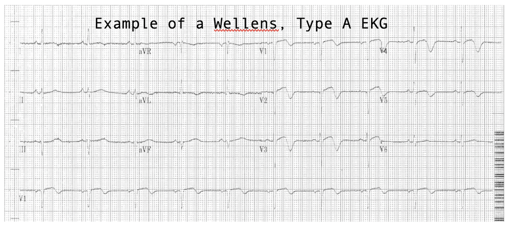 T Wave Inversions — Maimonides Emergency Medicine Residency