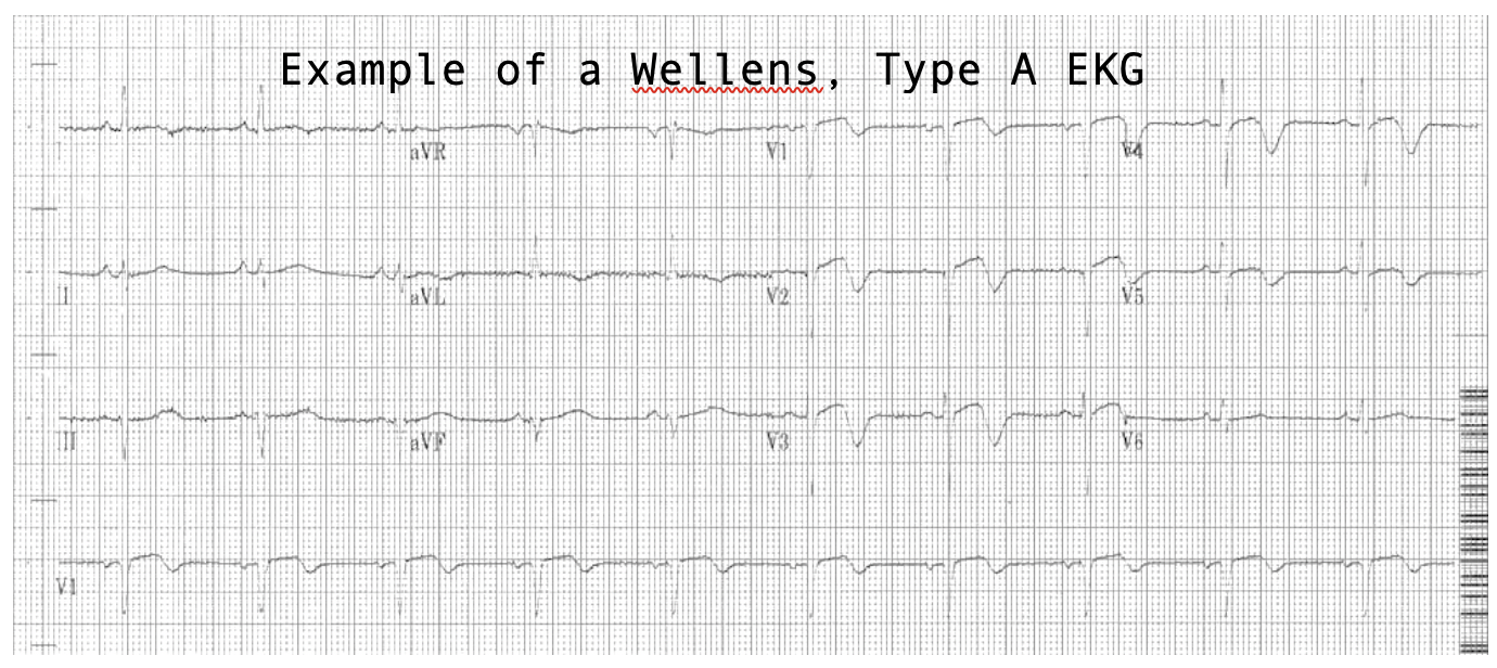 T Wave Inversions — Maimonides Emergency Medicine Residency