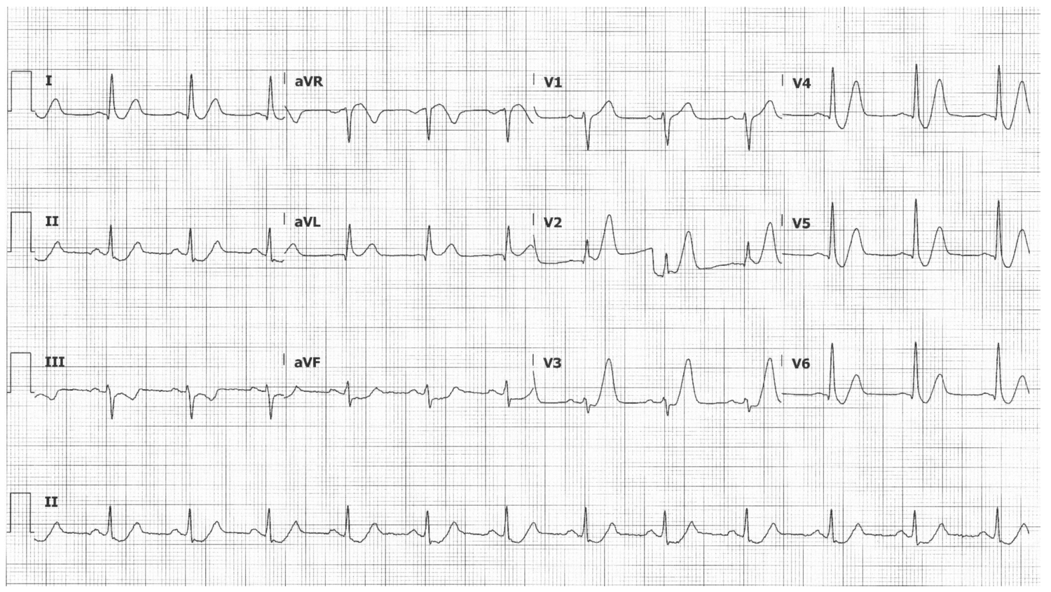 STEMI Equivalents — Maimonides Emergency Medicine Residency