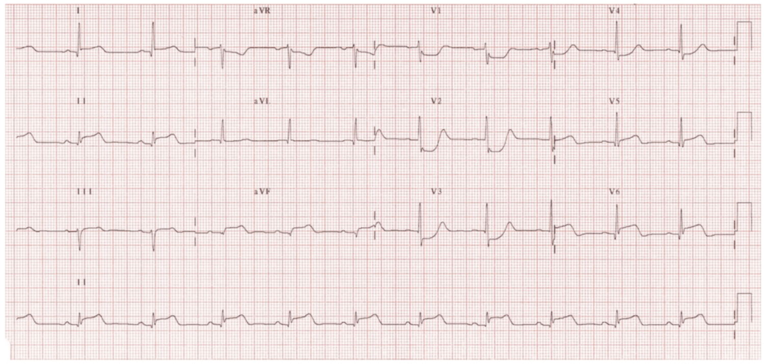 STEMI Equivalents — Maimonides Emergency Medicine Residency