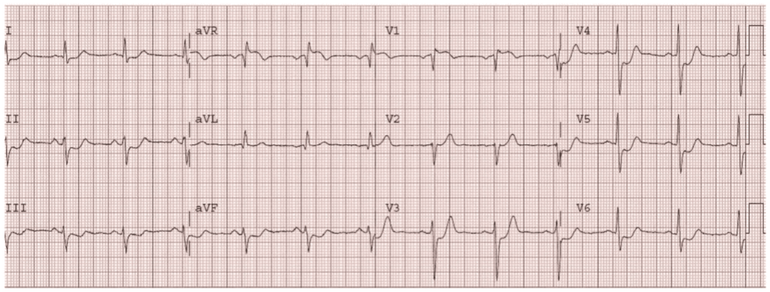 STEMI Equivalents — Maimonides Emergency Medicine Residency