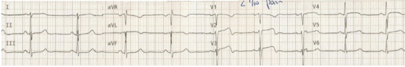 STEMI Equivalents — Maimonides Emergency Medicine Residency