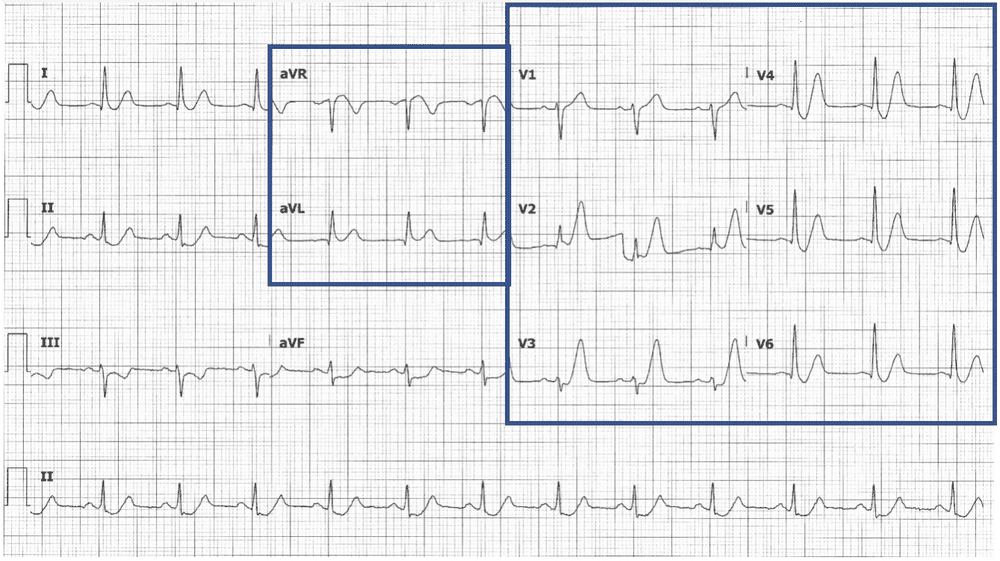 STEMI Equivalents — Maimonides Emergency Medicine Residency