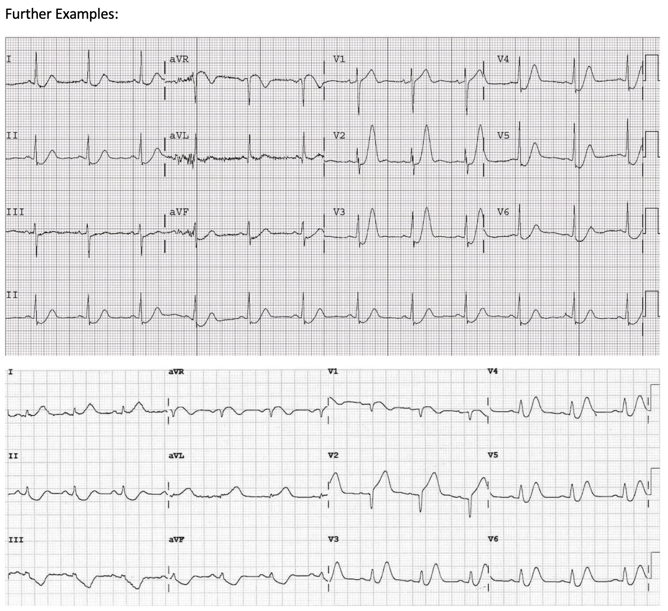 STEMI Equivalents — Maimonides Emergency Medicine Residency