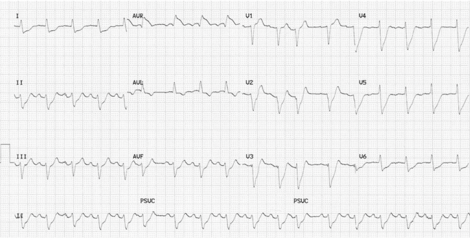 STEMI Equivalents — Maimonides Emergency Medicine Residency