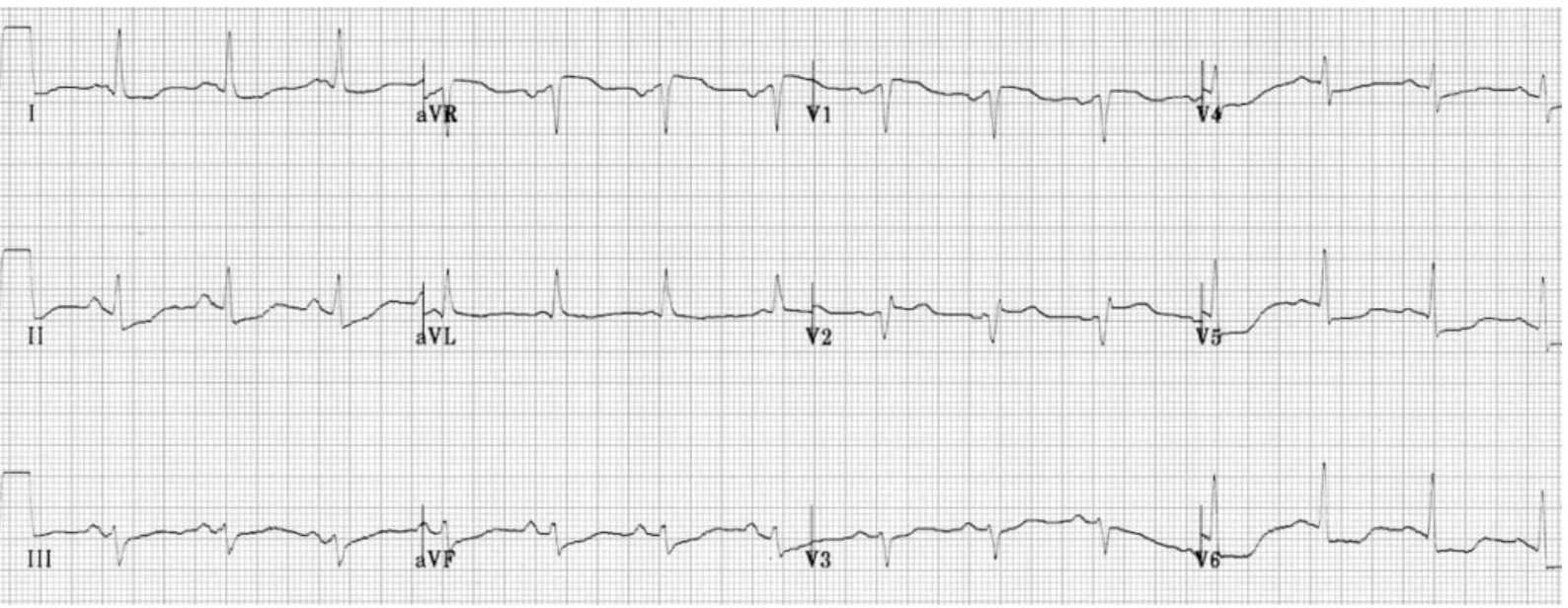 STEMI Equivalents — Maimonides Emergency Medicine Residency