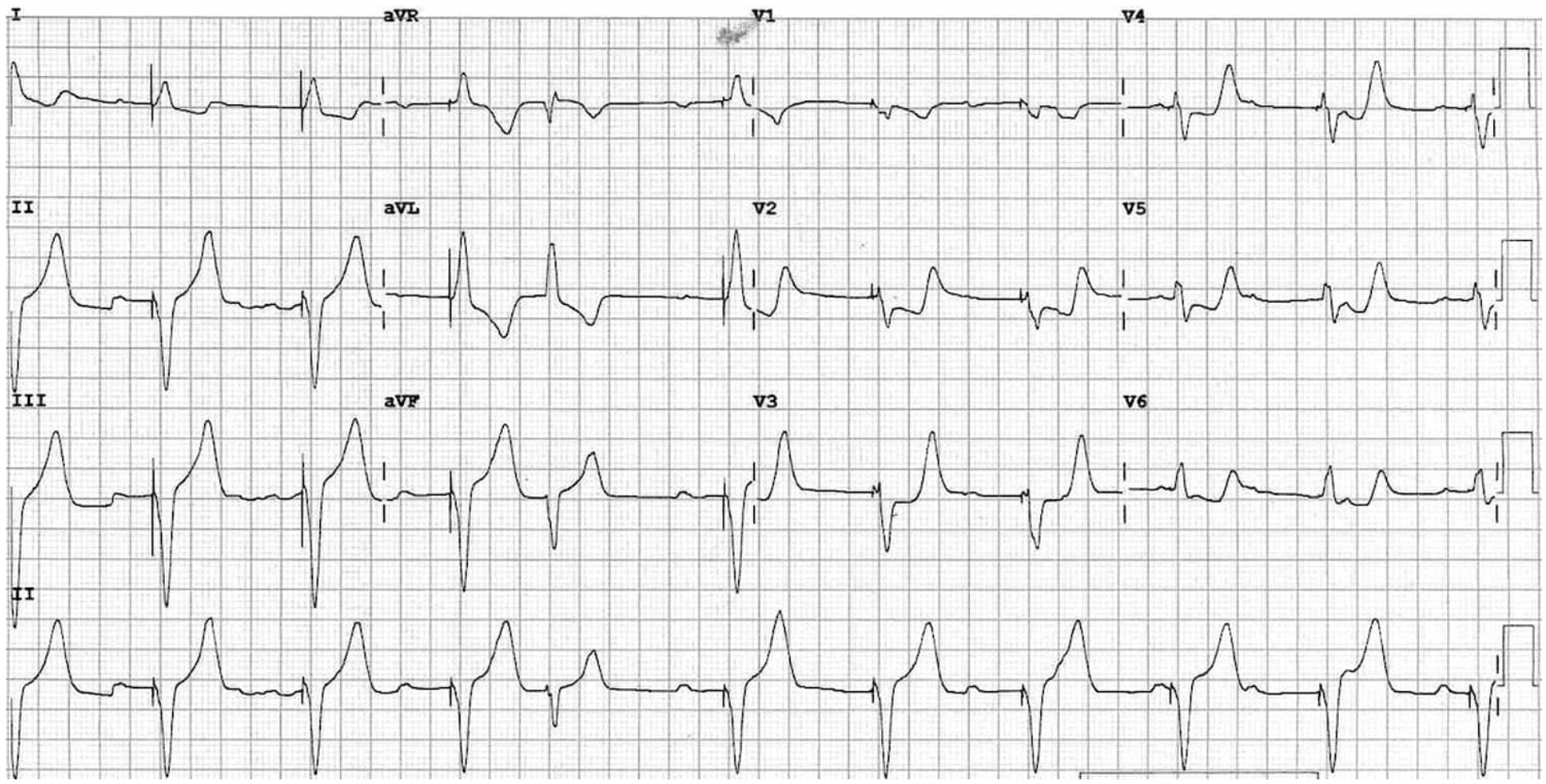 Left Bundle Branch Blocks + AMI — Maimonides Emergency Medicine Residency