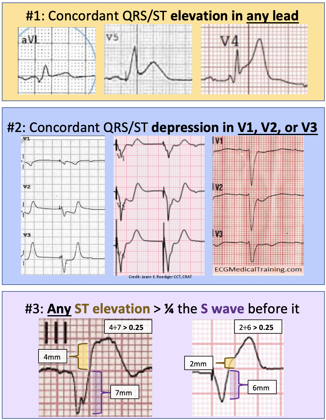 Left Bundle Branch Blocks + AMI — Maimonides Emergency Medicine Residency