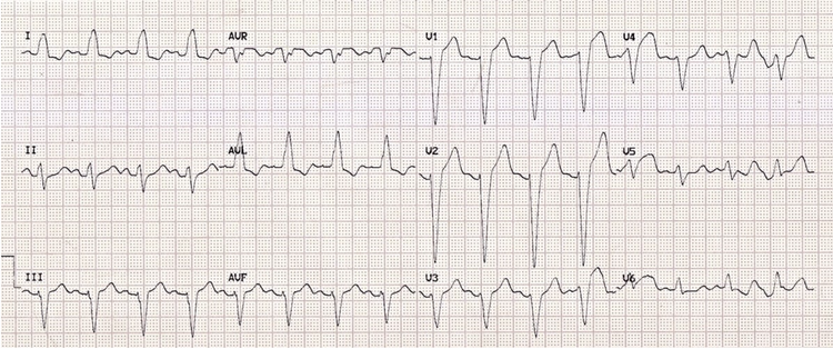 Left Bundle Branch Blocks + AMI — Maimonides Emergency Medicine Residency