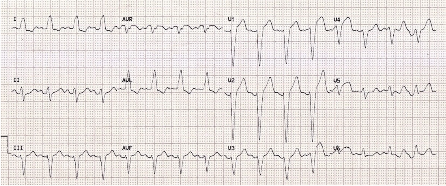 EKG — Blog — Maimonides Emergency Medicine Residency