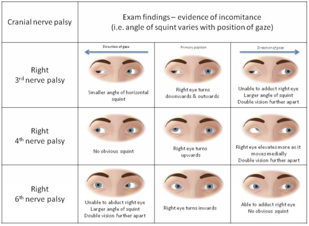 Sudden Onset Diplopia Work Up – Binocular Diplopia Symptoms – NRTC