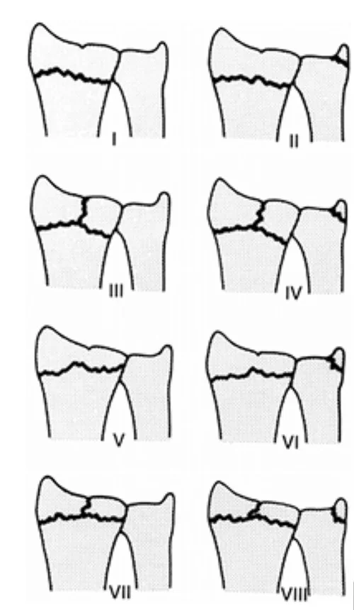 FOOSH Injuries — Maimonides Emergency Medicine Residency
