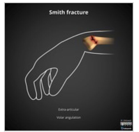 FOOSH Injuries — Maimonides Emergency Medicine Residency