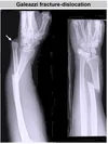 FOOSH Injuries — Maimonides Emergency Medicine Residency