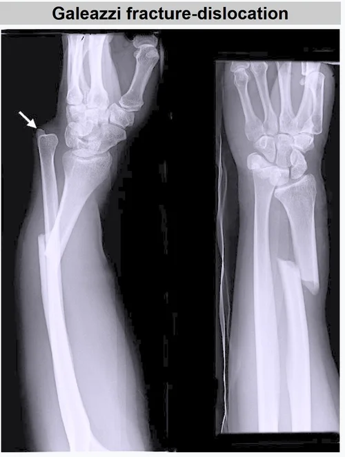 FOOSH Injuries — Maimonides Emergency Medicine Residency