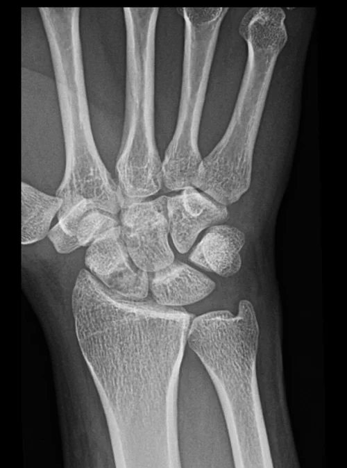 FOOSH Injuries — Maimonides Emergency Medicine Residency