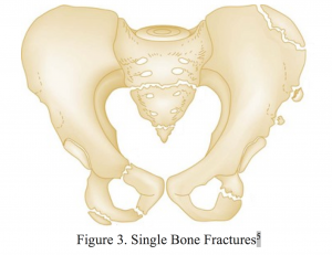 Pelvic Binders and Pelvic Fractures — Maimonides Emergency Medicine ...