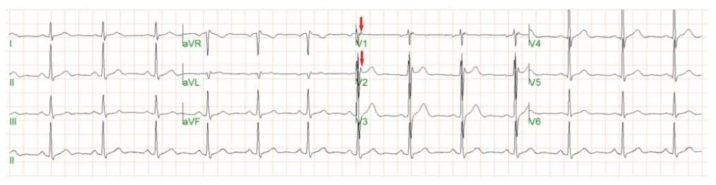 POTD: Arrhythmogenic Right Ventricular Dysplasia/Cardiomyopathy (ARVC ...
