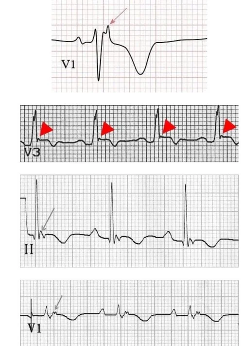 POTD: Arrhythmogenic Right Ventricular Dysplasia/Cardiomyopathy (ARVC ...