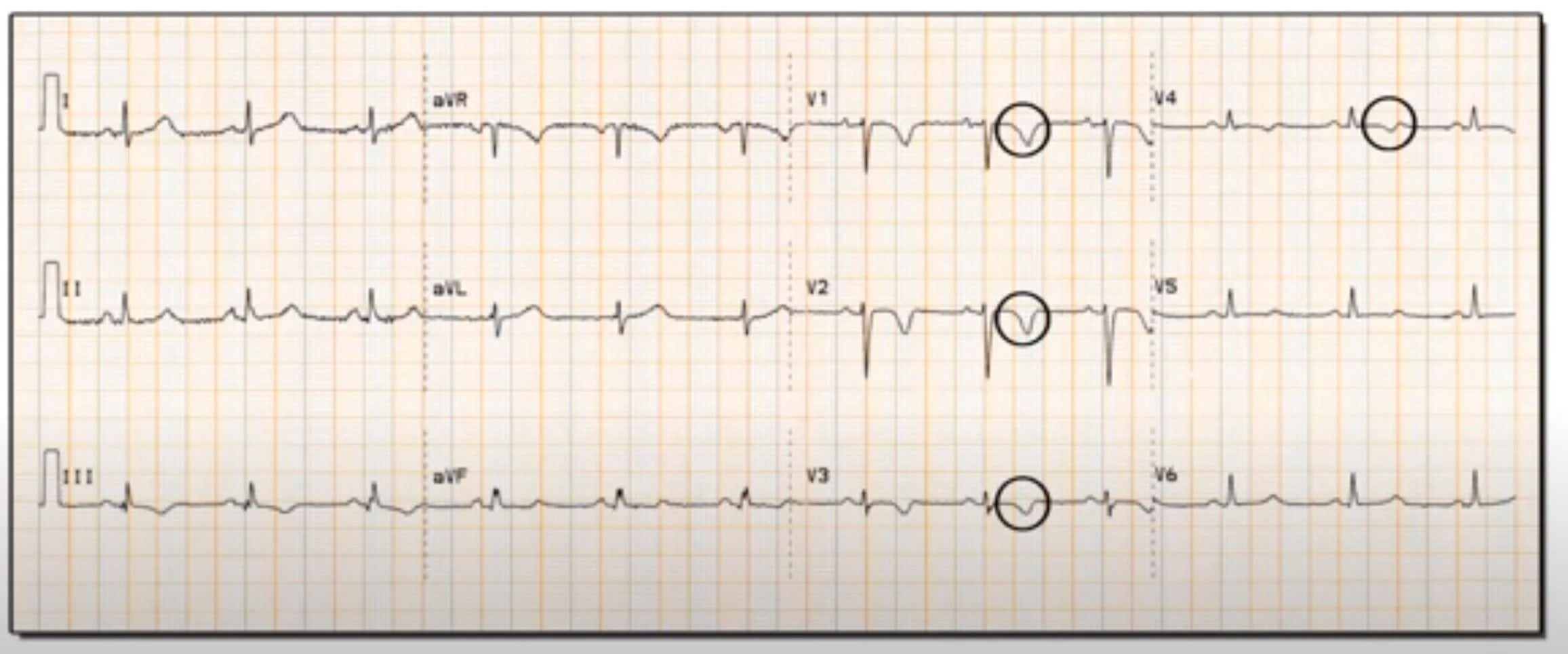 POTD: Arrhythmogenic Right Ventricular Dysplasia/Cardiomyopathy (ARVC ...