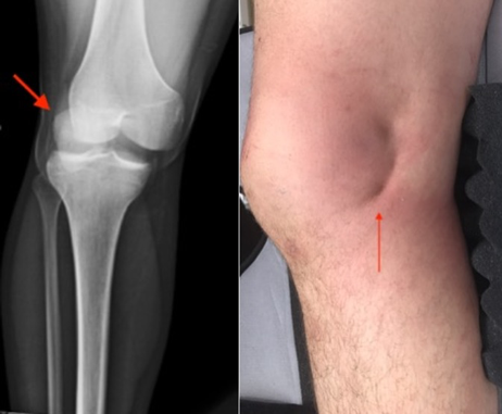 Knee Dislocation — Maimonides Emergency Medicine Residency