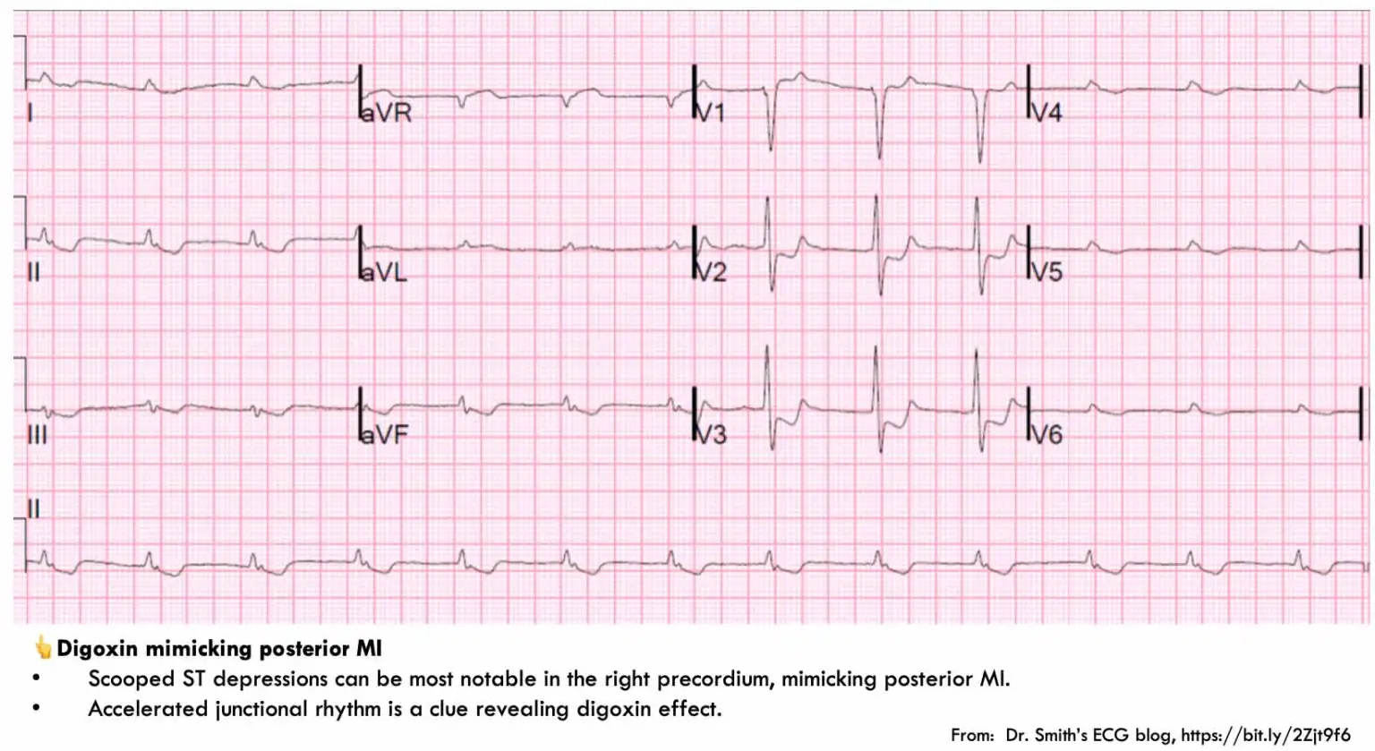 POTD: Digoxin toxicity — Maimonides Emergency Medicine Residency