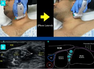 VOTW: Interscalene Brachial Plexus Block — Maimonides Emergency ...