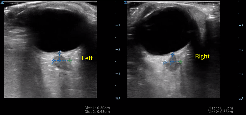 VOTW: Idiopathic Intracranial Hypertension — Maimonides Emergency ...