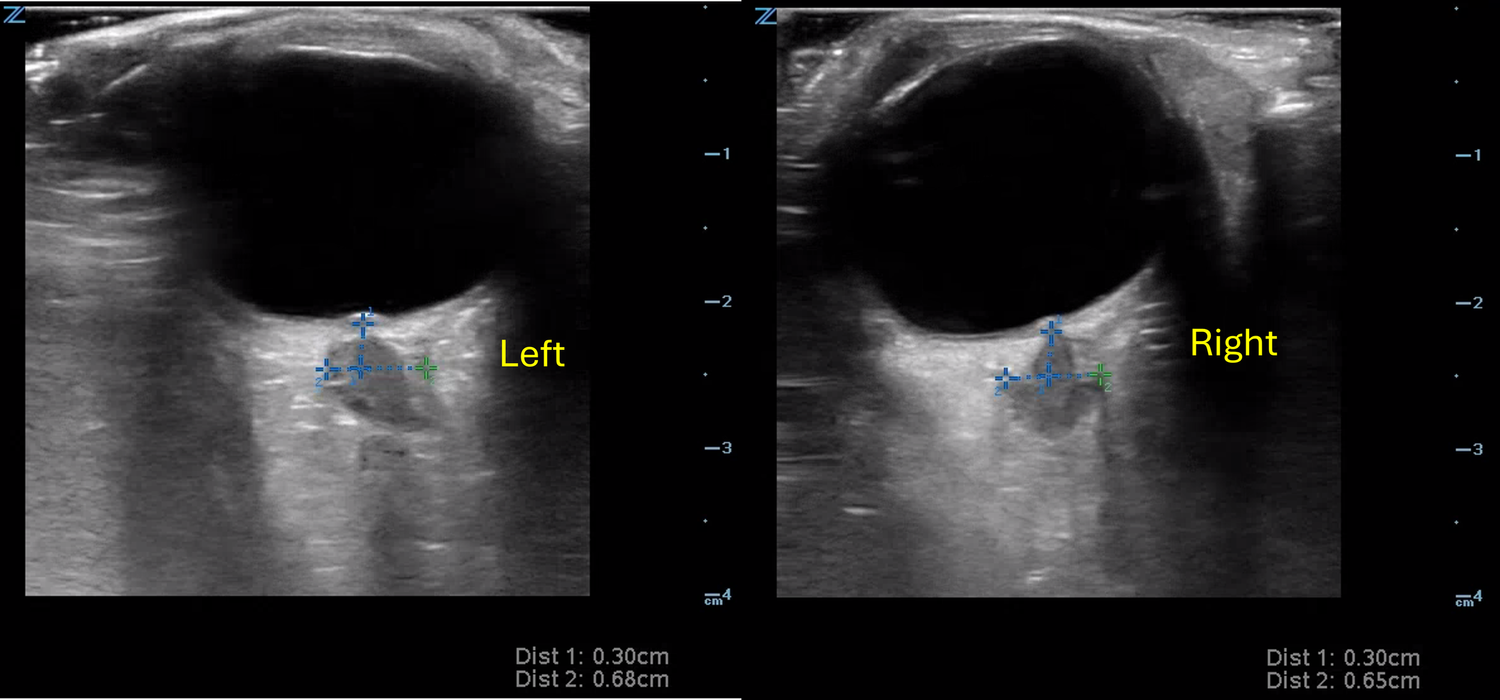VOTW: Idiopathic Intracranial Hypertension — Maimonides Emergency ...