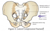 Unstable Pelvic Ring Fractures — Maimonides Emergency Medicine Residency