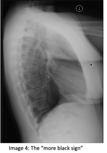 CXR- Consolidation or Atelectasis? — Maimonides Emergency Medicine ...