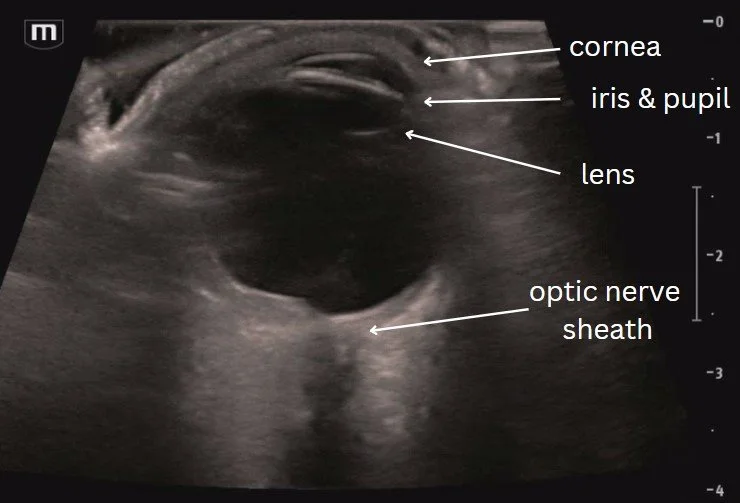 VOTW: "Eye-Yahh!" — Maimonides Emergency Medicine Residency
