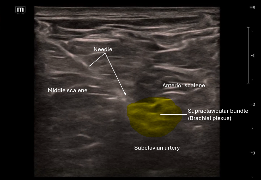 VOTW: Supraclavicular Nerve Block — Maimonides Emergency Medicine Residency