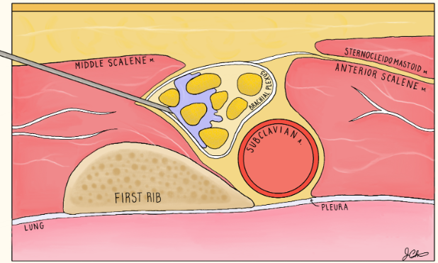 VOTW: Supraclavicular Nerve Block — Maimonides Emergency Medicine Residency