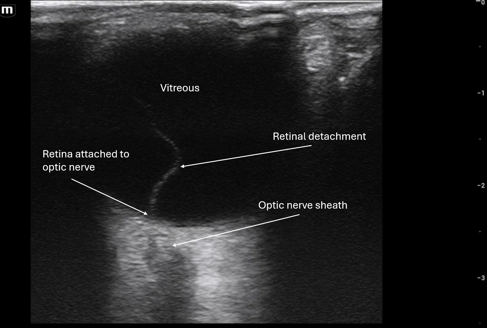 VOTW: Eye for an Eye — Maimonides Emergency Medicine Residency