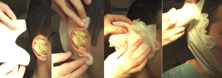 POTD: Auricular Lacerations — Maimonides Emergency Medicine Residency