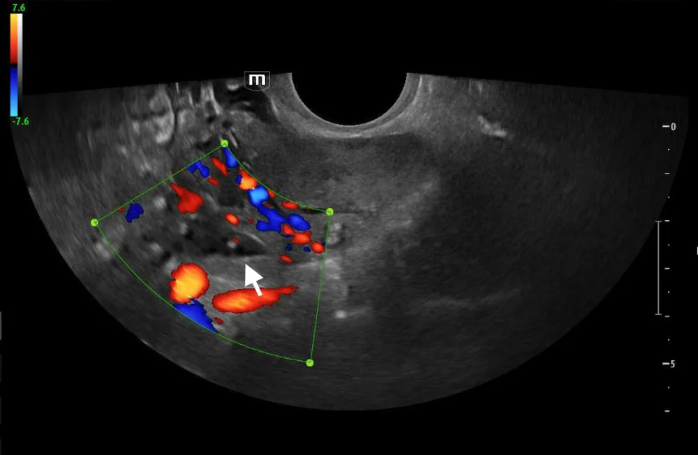 VOTW: Tube-y or not Tube-y: Two Cases of Ectopic Pregnancy — Maimonides ...
