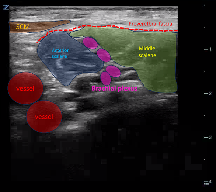 VOTW: Interscalene Brachial Plexus Block — Maimonides Emergency ...