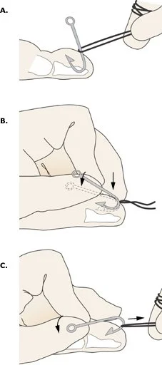 POTD: Fishhook Injury — Maimonides Emergency Medicine Residency