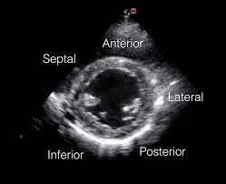 VOTW: Regional Wall Motion Abnormality — Maimonides Emergency Medicine ...