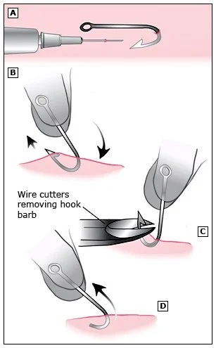 POTD: Fishhook Injury — Maimonides Emergency Medicine Residency