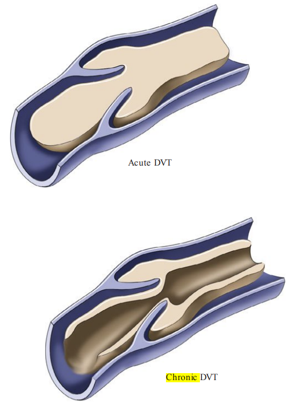 DVT — Educational Blog — Maimonides Emergency Medicine Residency
