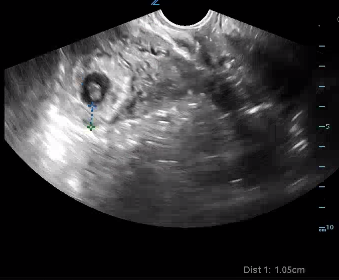 VOTW: Interstitial Ectopic Pregnancy — Maimonides Emergency Medicine ...