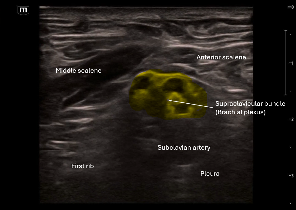 VOTW: Supraclavicular Nerve Block — Maimonides Emergency Medicine Residency