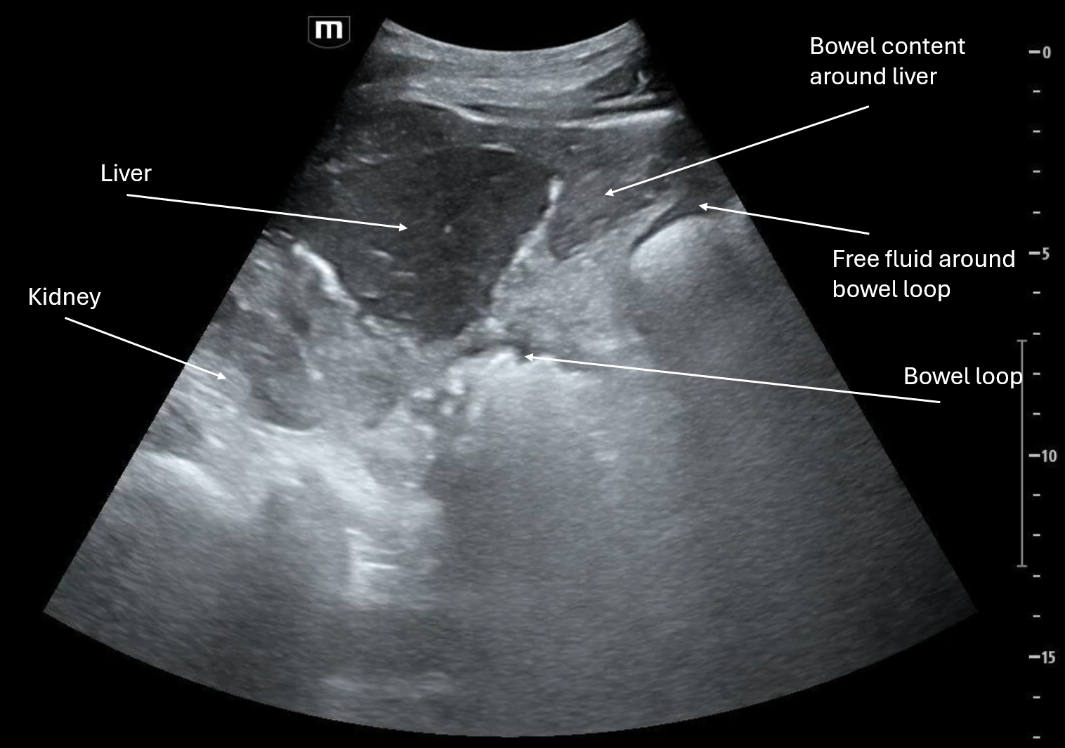 VOTW: Blood or Bowel? — Maimonides Emergency Medicine Residency