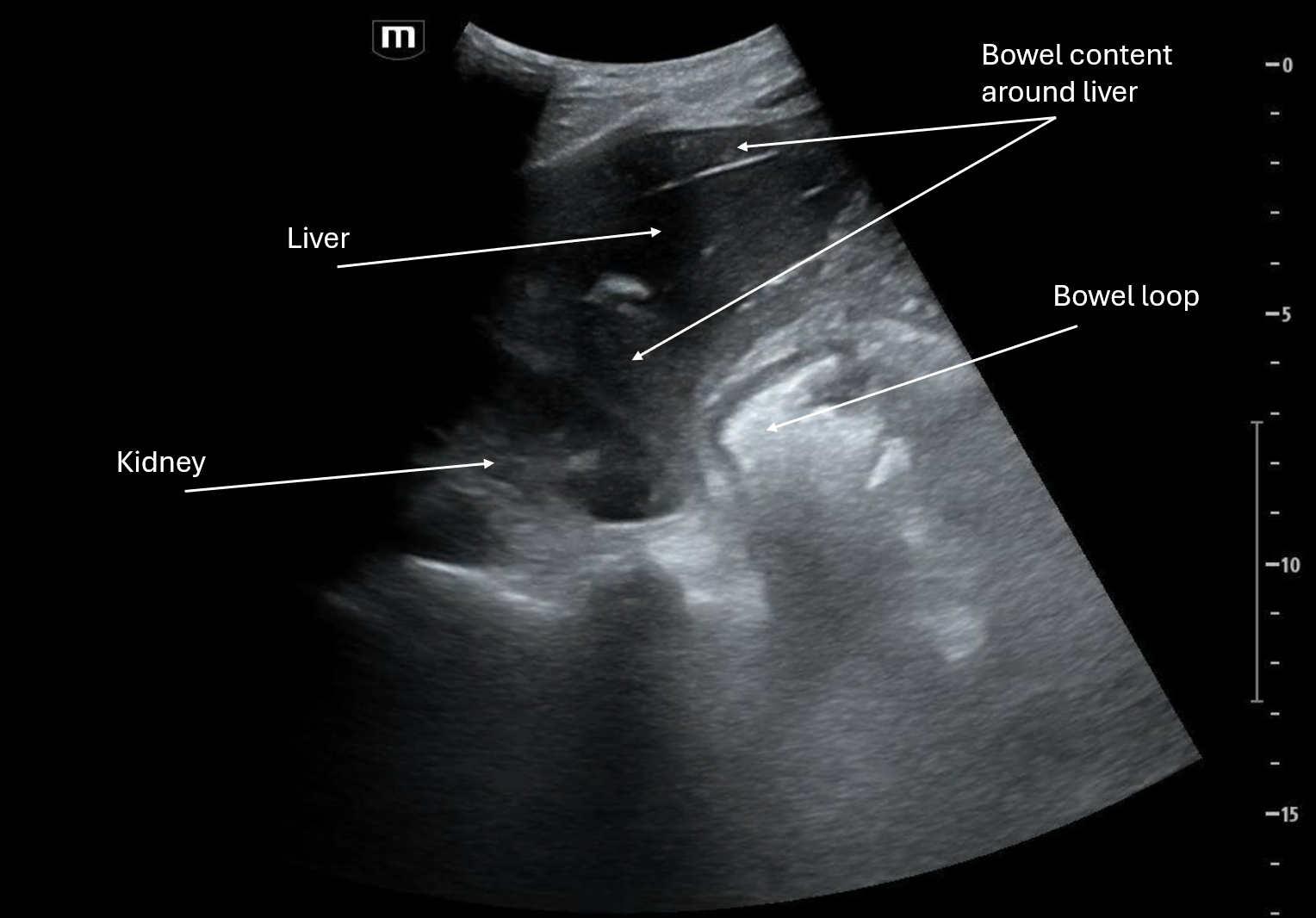 VOTW: Blood or Bowel? — Maimonides Emergency Medicine Residency