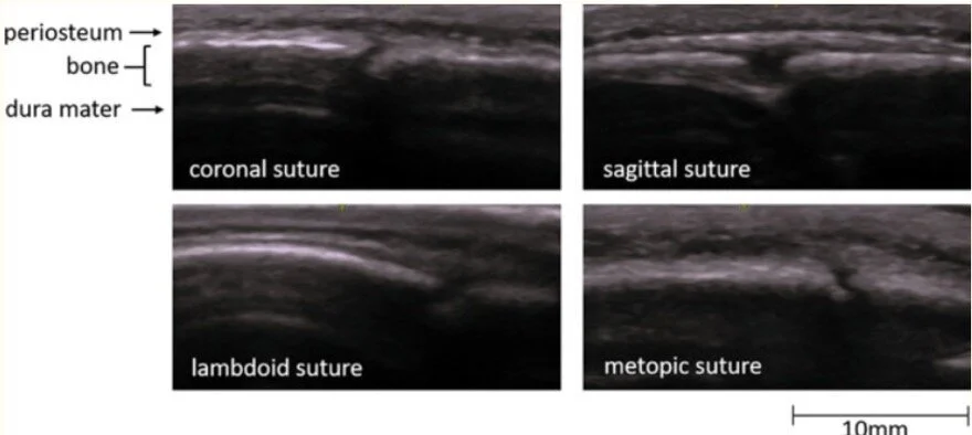 VOTW: Pediatric Skull Fracture — Maimonides Emergency Medicine Residency