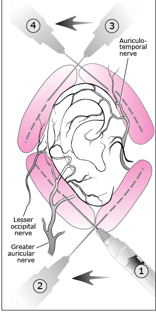 POTD: Auricular Lacerations — Maimonides Emergency Medicine Residency